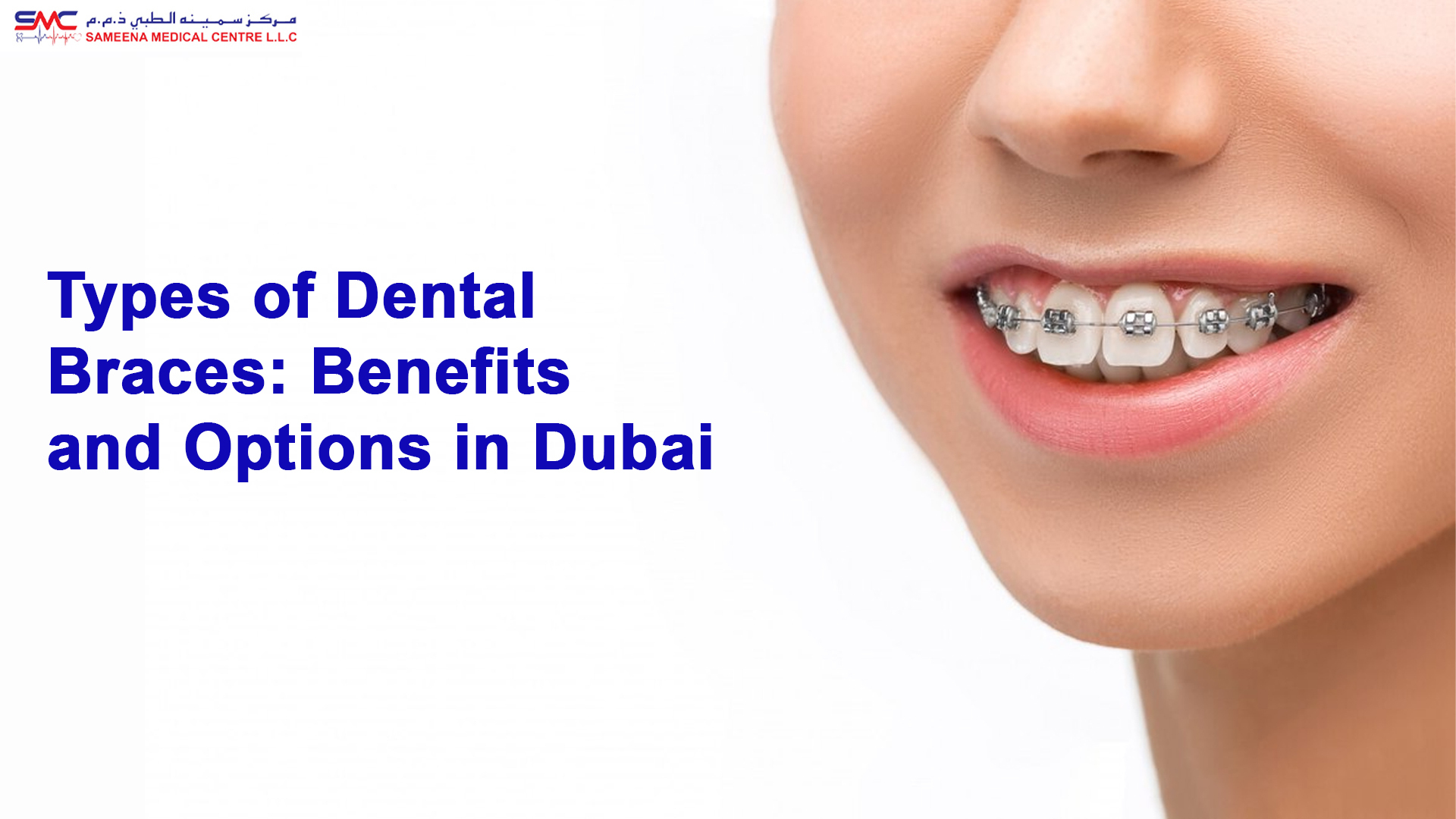 Types of Dental Braces: Benefits and Options in Dubai